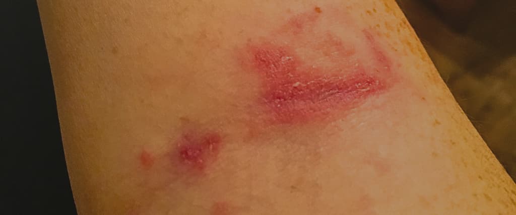 How To Manage Allergy To Adhesive Bandages And Tapes My Healthy Balance